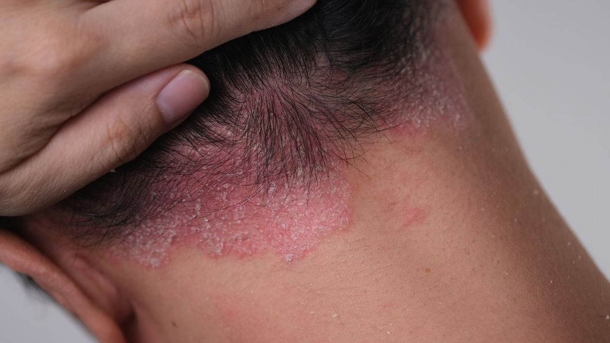 La dermatitis atópica: cuando la picazón persistente impacta en la ...